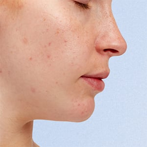 How To Clear It Up Like a Derm | Blemish 101 | CeraVe