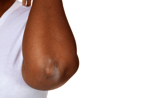 rough bumpy skin on elbows